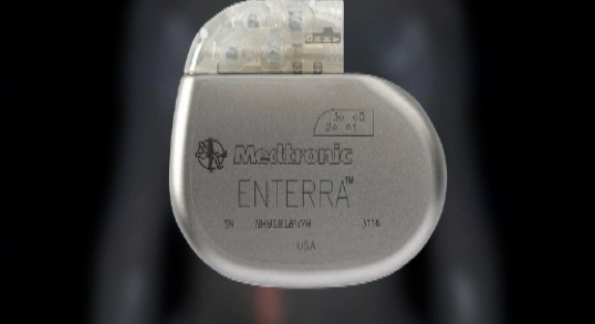 Gastric pacemaker changes First Coast Lives | firstcoastnews.com